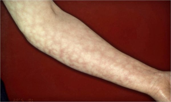 Livédo - Les Clés du Diagnostic